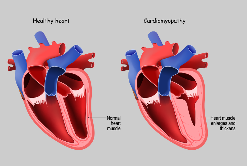 Gene Therapy Shows Promise for Life-Threatening Inherited Heart Disease ...